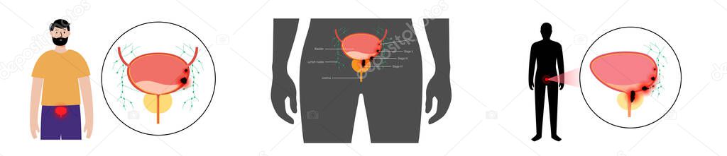 Stages of bladder cancer Vector Art Stock Images | Depositphotos