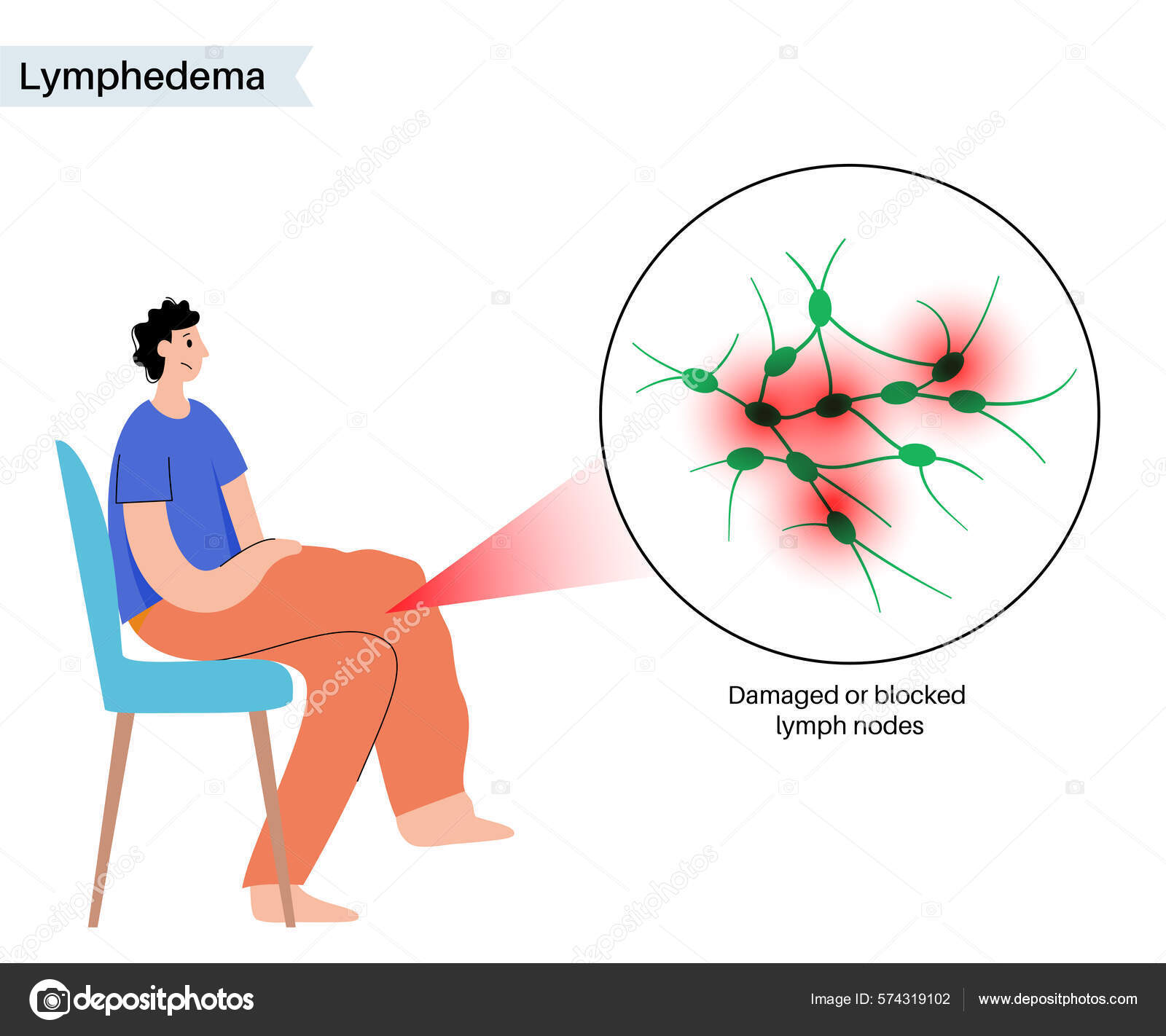 Lymphedema Betegség Koncepció Nőstény Lábak Vagy Karok Duzzanata Sérült ...