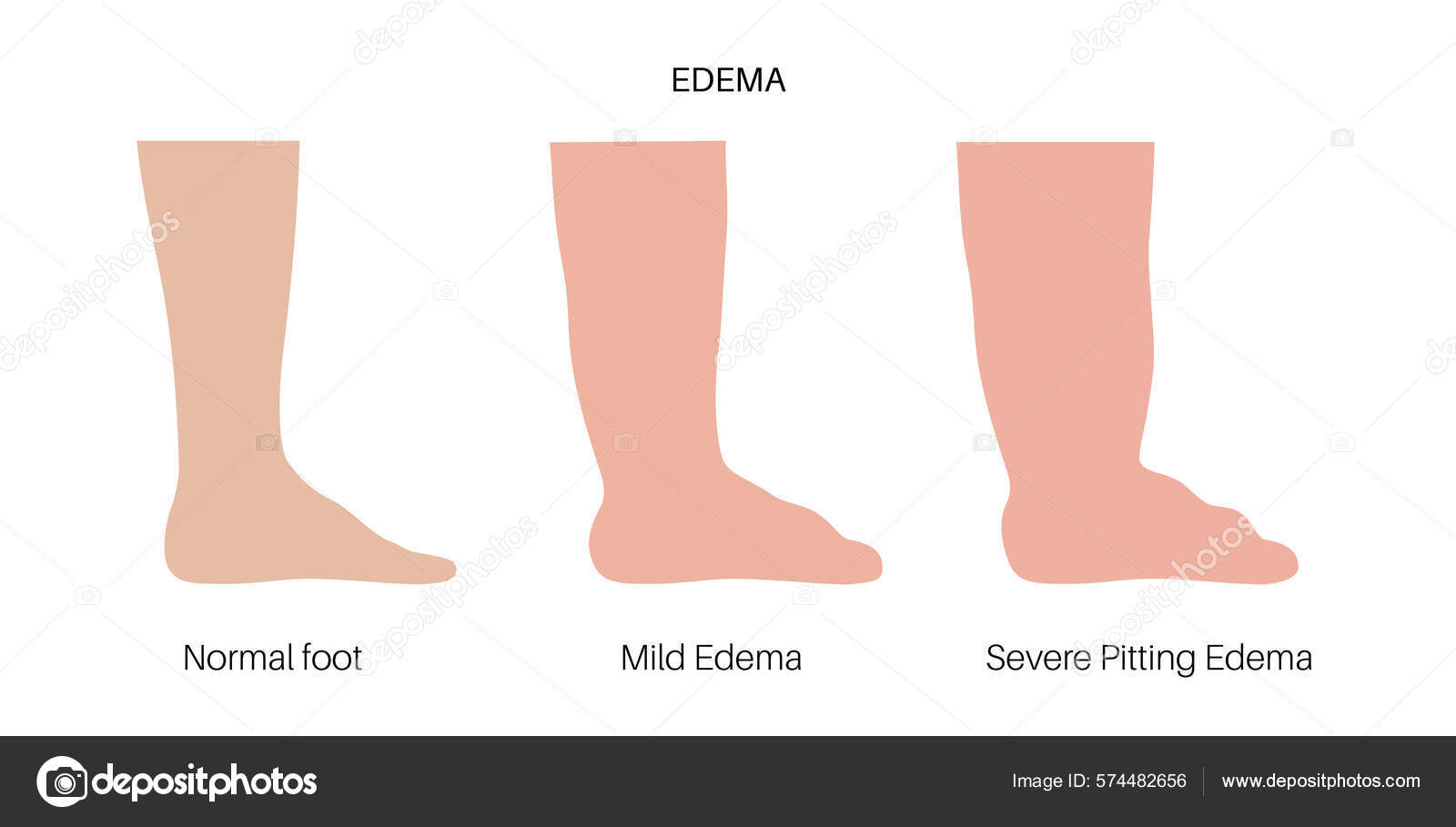 Concepto Enfermedad Edema Edema Trastorno Retención Líquidos ...