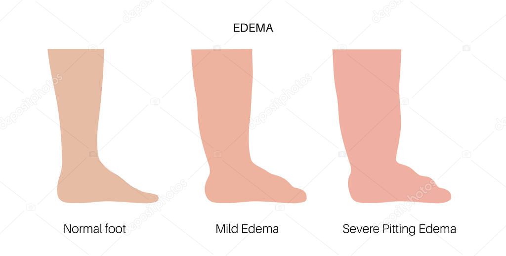 Concepto de enfermedad de Edema. Edema o trastorno de retención de líquidos. Inflamación en las ...