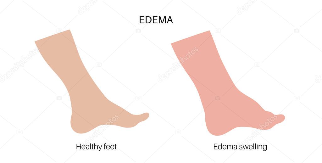 Concepto de enfermedad de Edema. Edema o trastorno de retención de ...