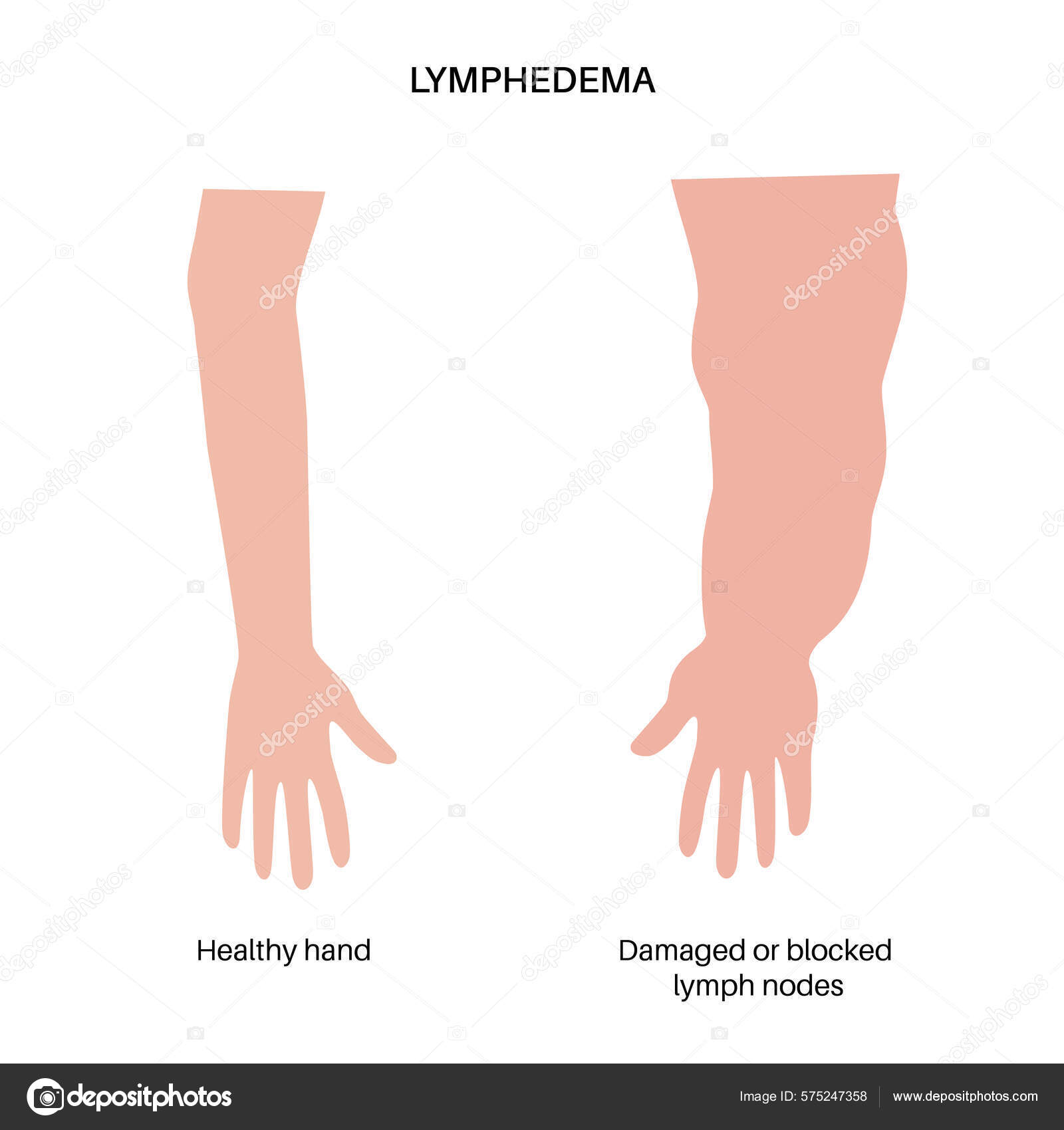 Lymphedema Arm
