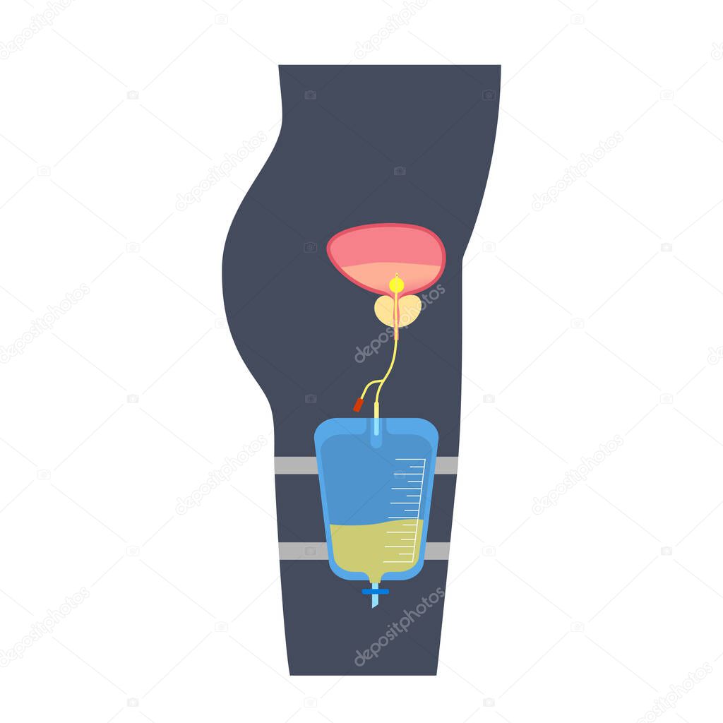 Catéter urinario en cuerpo masculino. Vaciar la vejiga y recoger la ...