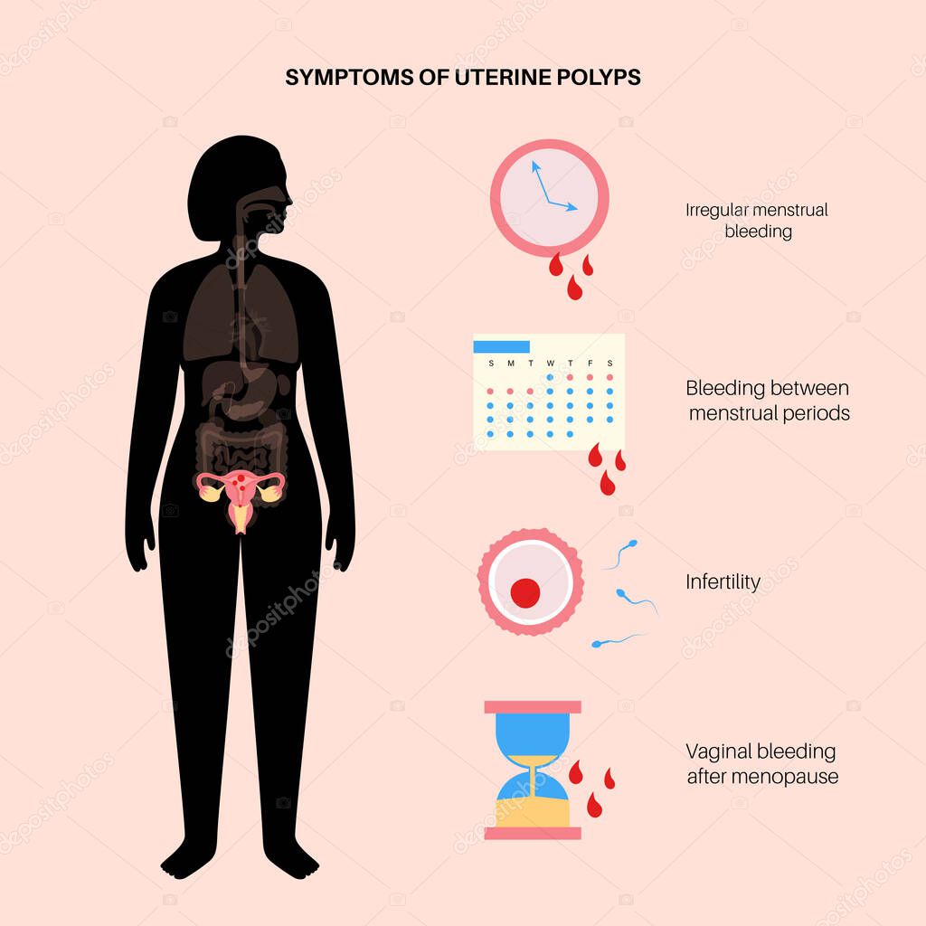 Lista 104+ Foto Imágenes De Pólipos En El útero Alta Definición ...