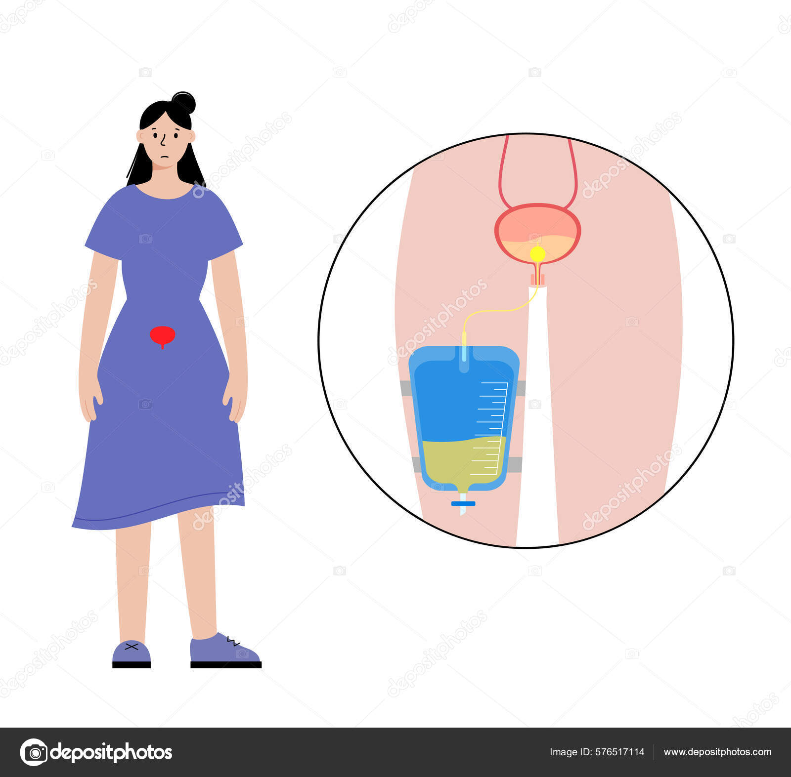 Kateter Urin Dalam Tubuh Wanita Kandung Kemih Kosong Dan Mengumpulkan ...