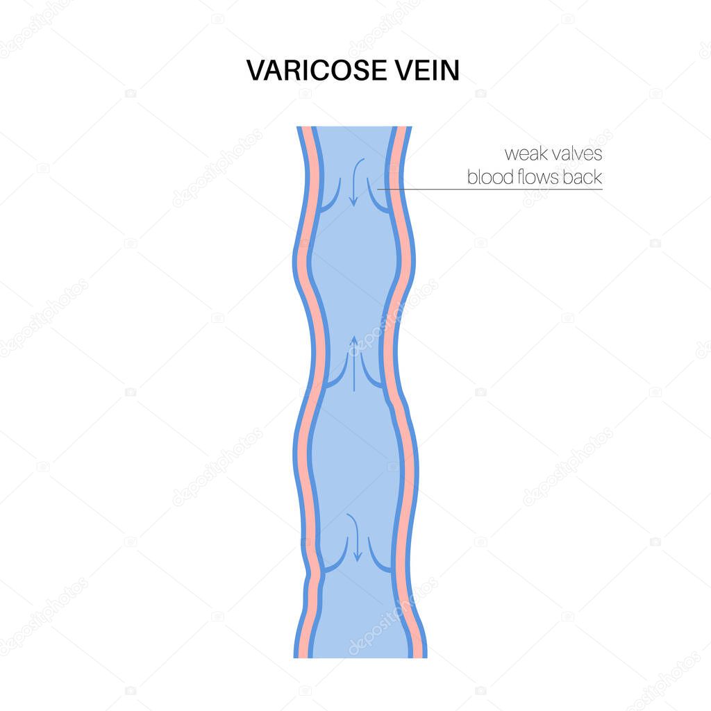 Concepto de venas varicosas. Hinchazón y dolor en las piernas humanas ...
