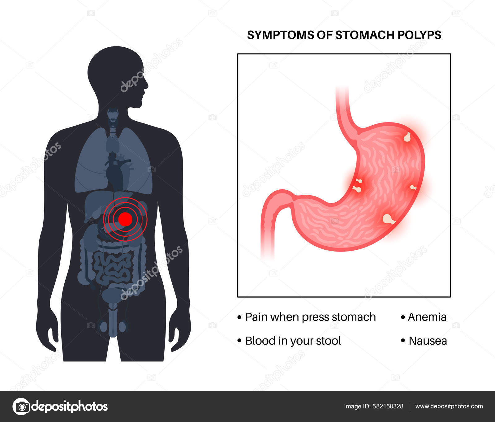 Diagnóstico Extracción Pólipos Estomacales Clínica Concepto ...