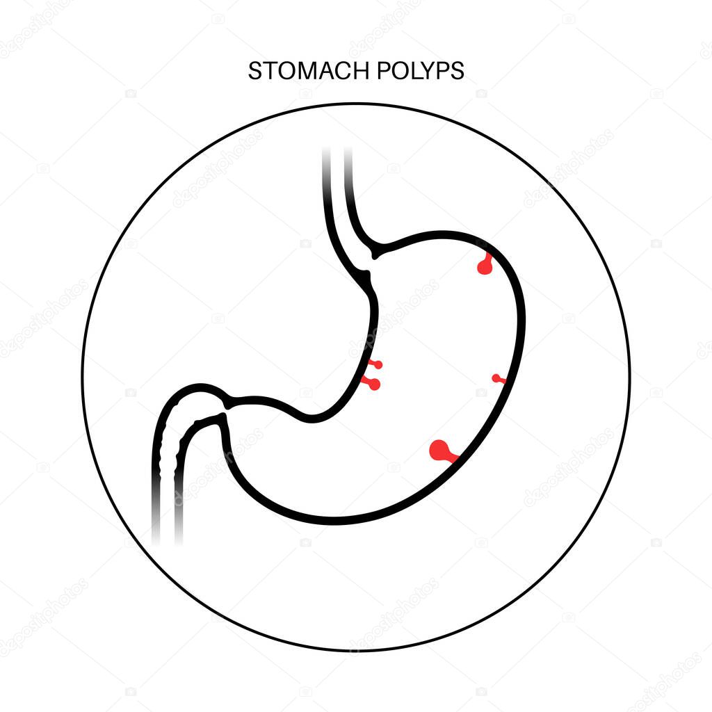 Logo de pólipos estomacales, neoplasias diagnósticas y de extirpación ...