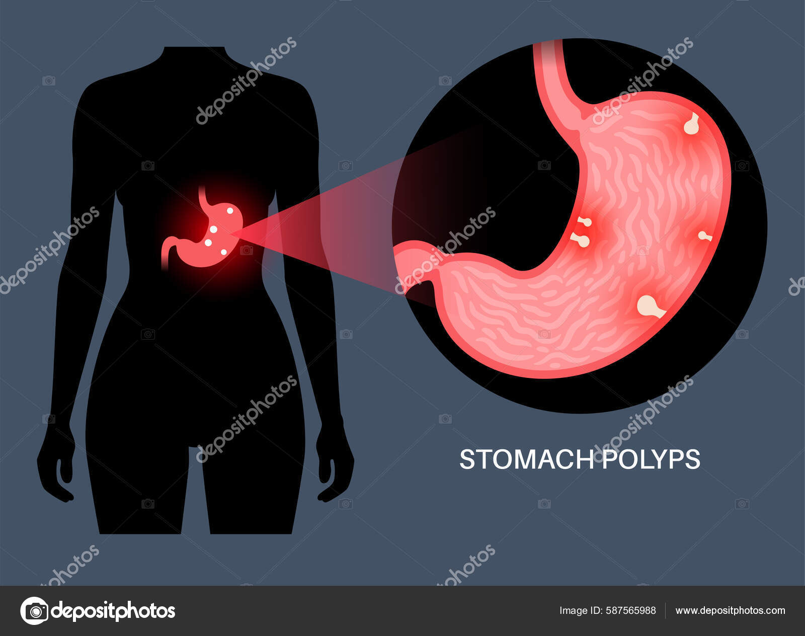 Gyomorpolip Diagnosztika Eltávolítás Klinikán Endoszkópos Eljárás ...