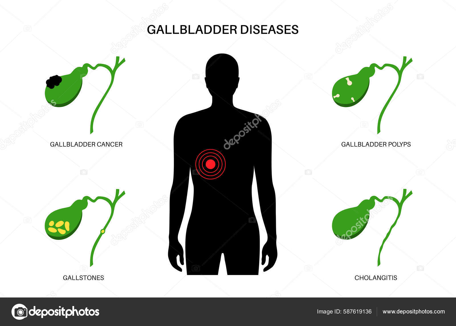 Gallbladder Diseases Infographic Gallstone Cancer Acute Cholecystitis ...