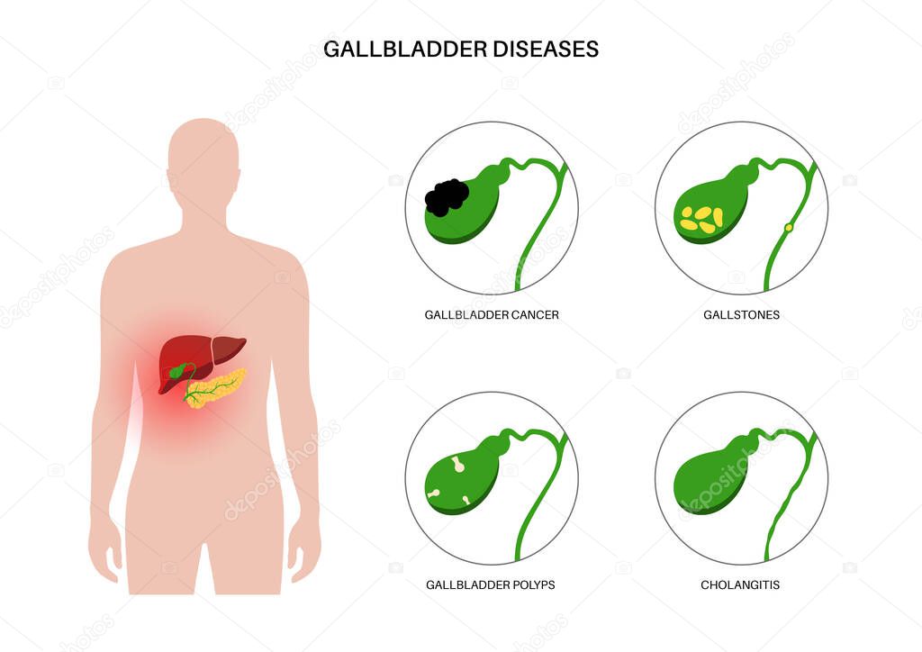 Gallbladder diseases infographic. Gallstone, cancer, acute ...