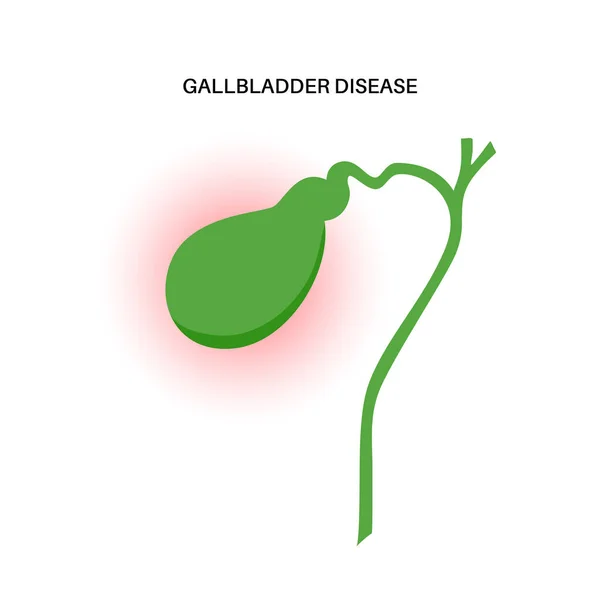 Gallbladder Diseases Infographic Gallstone Cancer Acute Cholecystitis ...