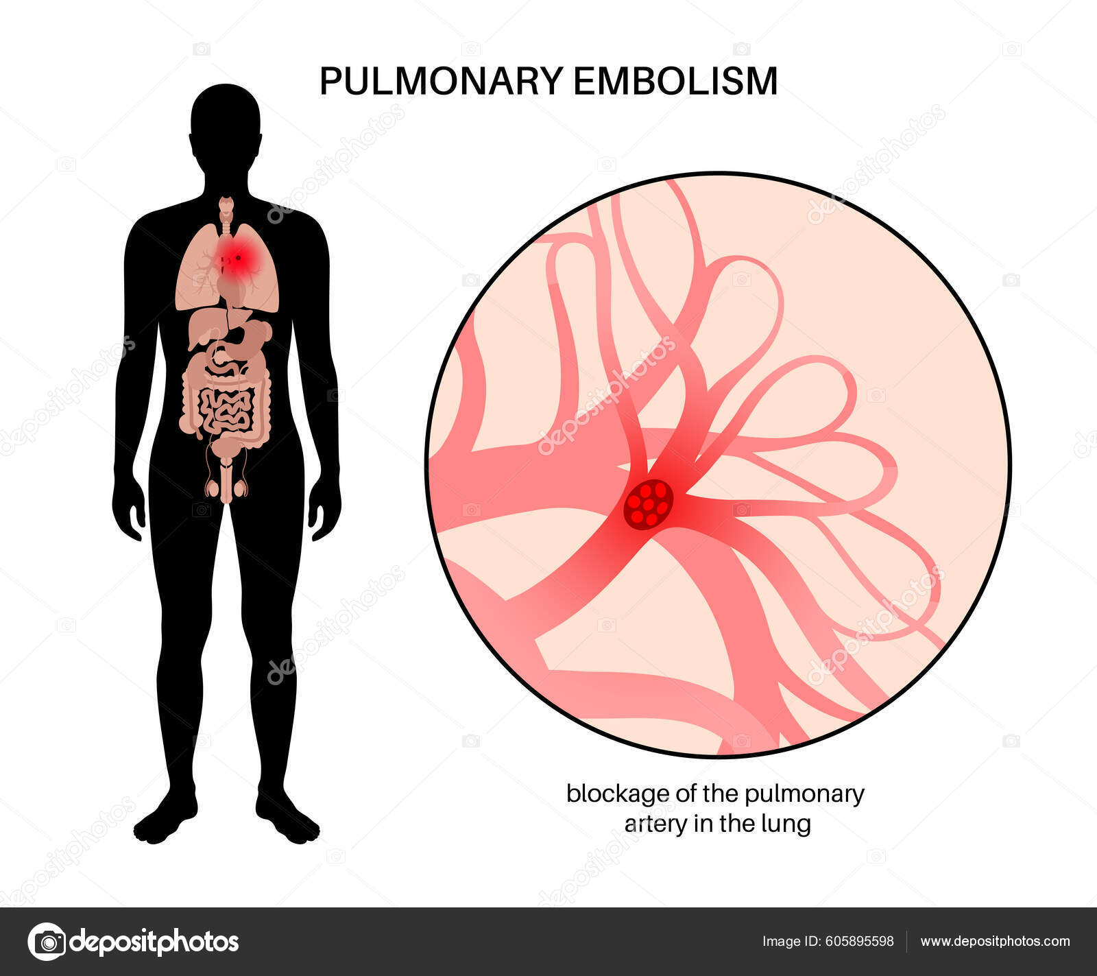 Pulmonary Embolism Disease Deep Vein Thrombosis Male Body Blood Clot ...