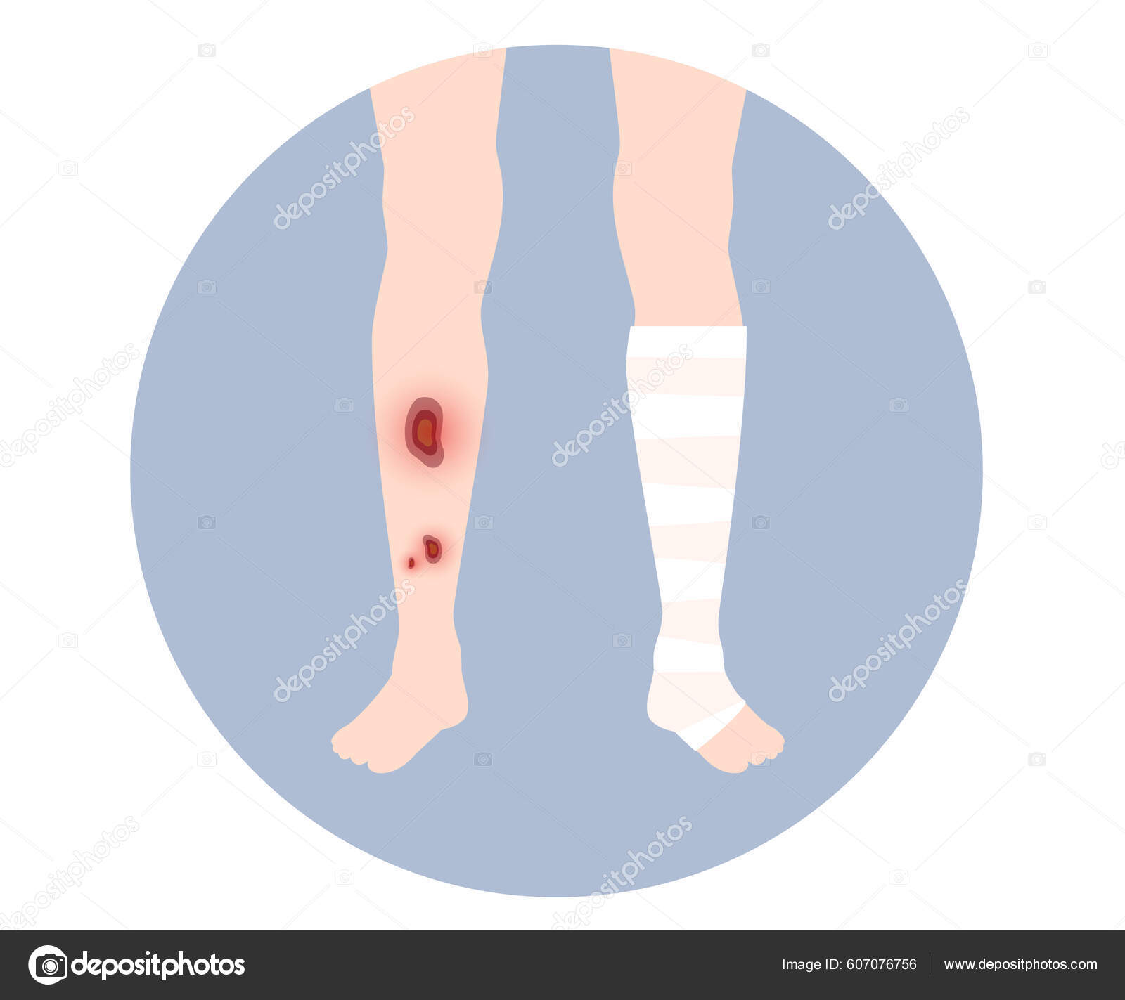 Sore Cut Ulcer Human Leg Elastic Bandage Wrap Medical Gauze Stock ...