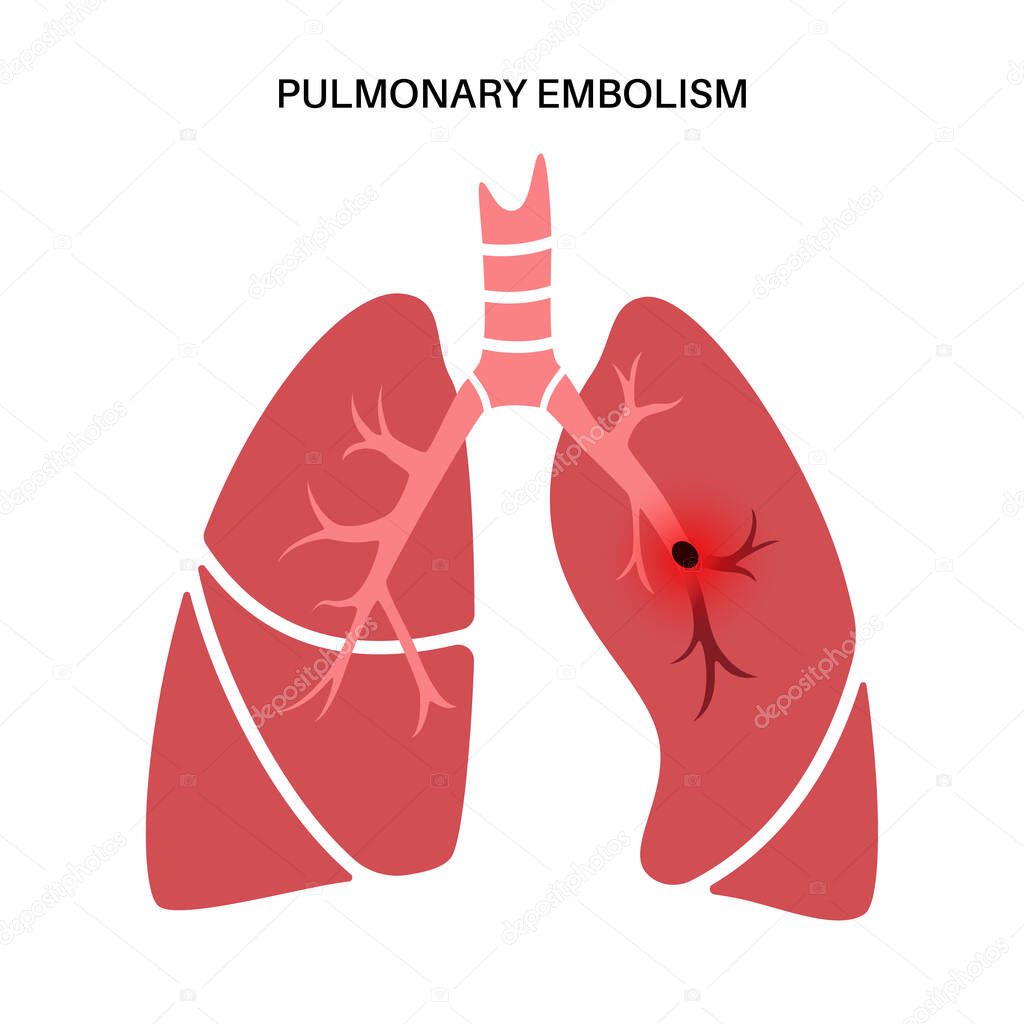 Enfermedad por embolia pulmonar. Trombosis venosa profunda. Coágulo de ...