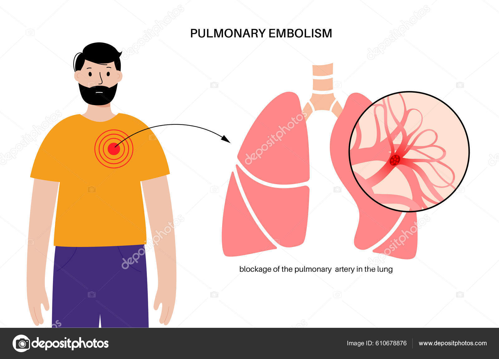 Pulmonary Embolism Disease Deep Vein Thrombosis Male Cartoon Body Blood ...