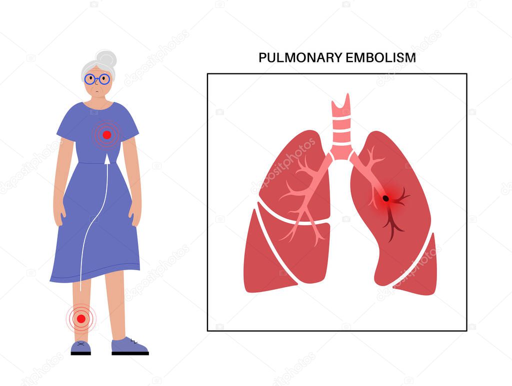 Enfermedad por embolia pulmonar. Paciente madura. Una anciana con ...