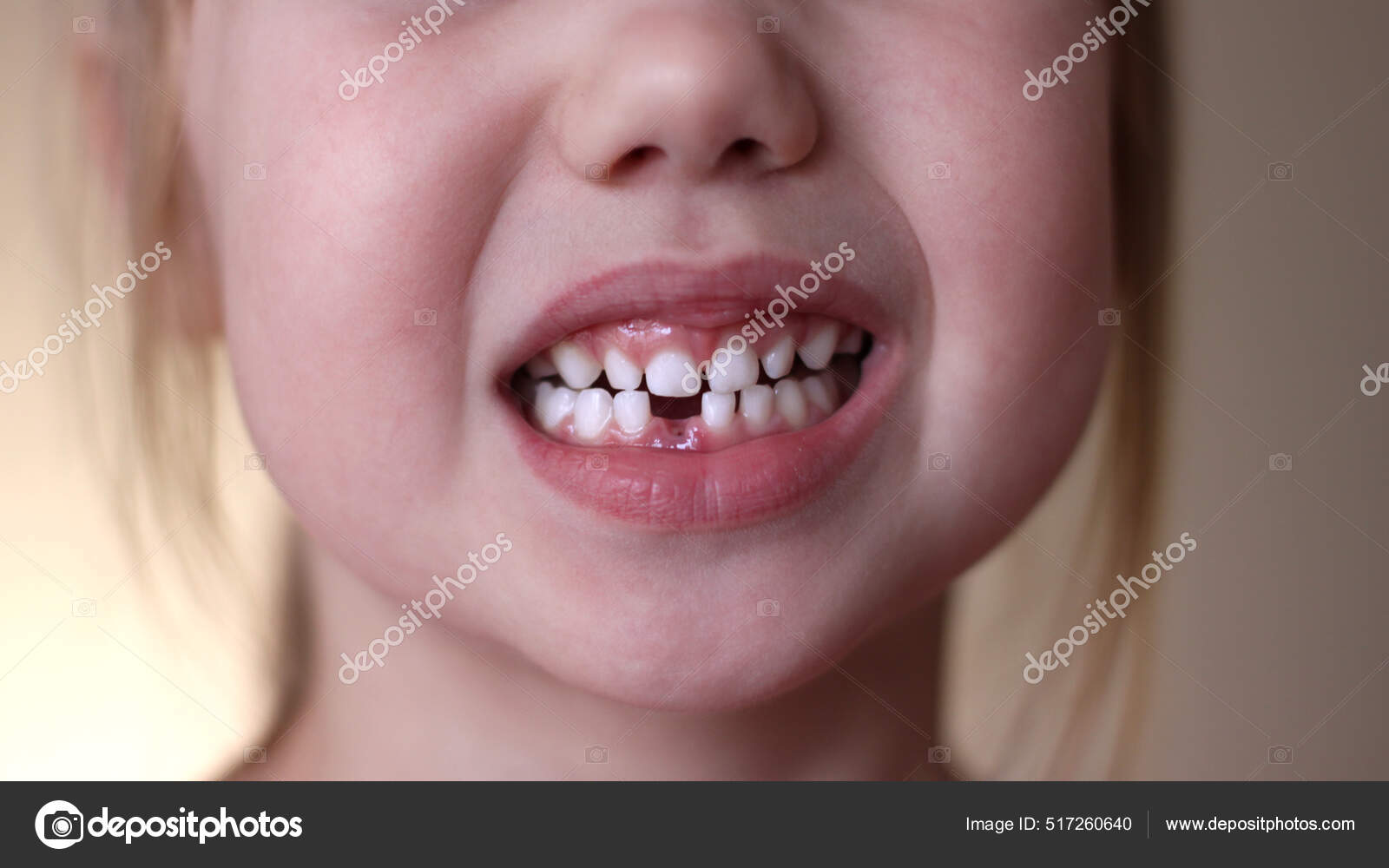 A little girl of 4 years old had baby teeth. Close-up of the girls ...