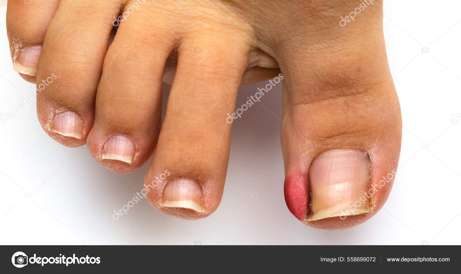 Macro Lady's Big Toe Ingrown Toenail Red Swollen Skin Due — Stock Photo ...
