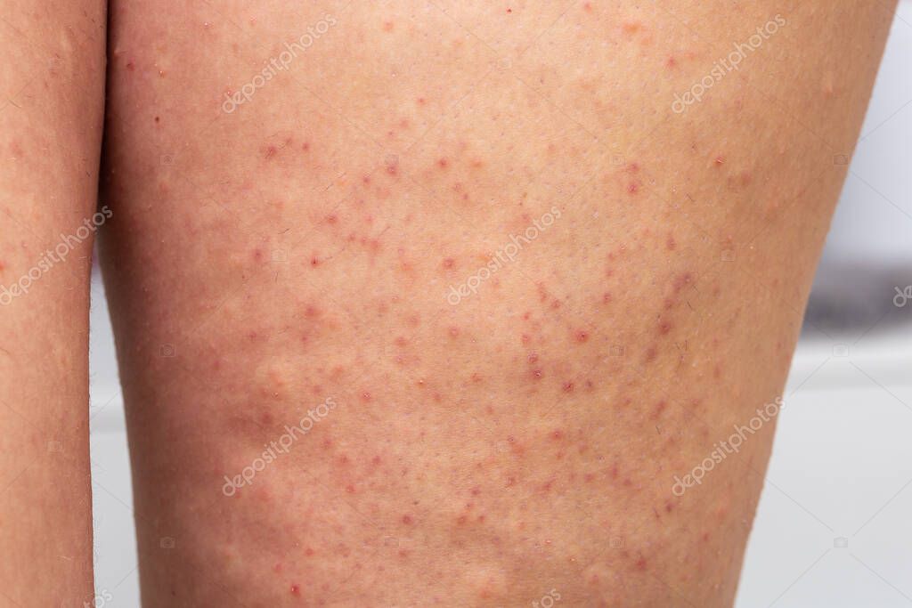 primer plano de las piernas de la mujer con queratosis pilar, una ...