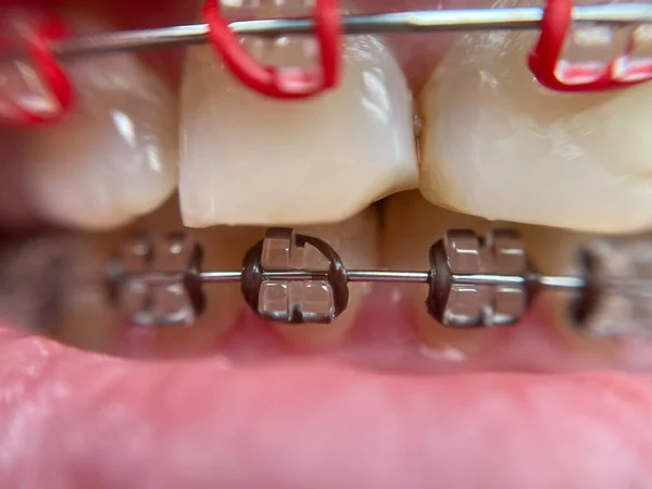 Dental braces super macro , crooked teeth, broken sapphire braces ...