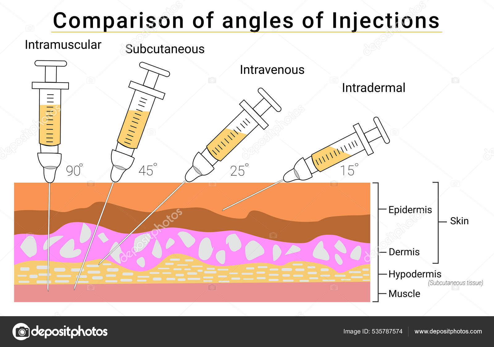 Vector Van Vergelijking Van Hoeken Van Injecties Illustratie Van ...