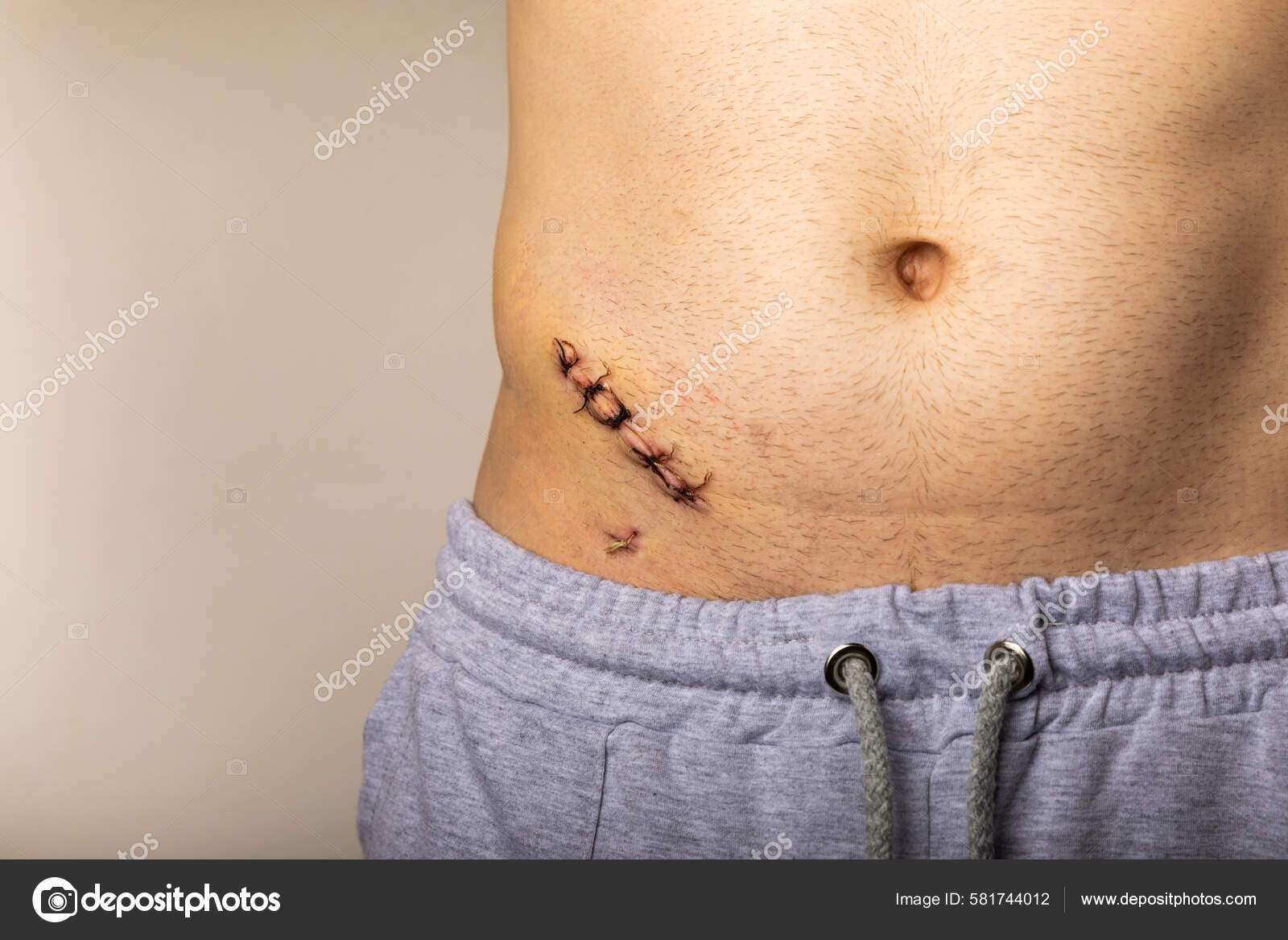 Ein Mann Zeigt Eine Blinddarmnarbe Bauch Eine Narbe Von Einer - Stockfotografie: lizenzfreie ...