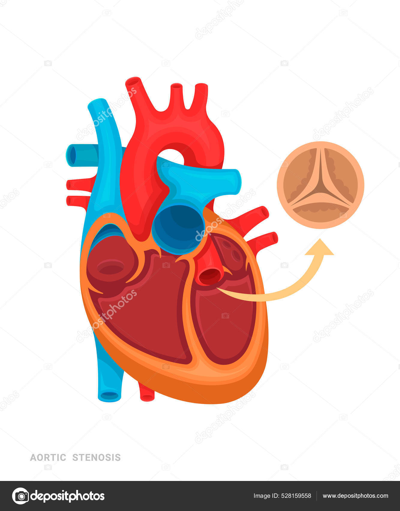 Heart Defect Aortic Stenosis Illustration Medicine Books Websites Apps ...