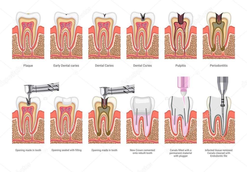 Ilustraciones médicas del tratamiento dental. Etapas de caries de un ...
