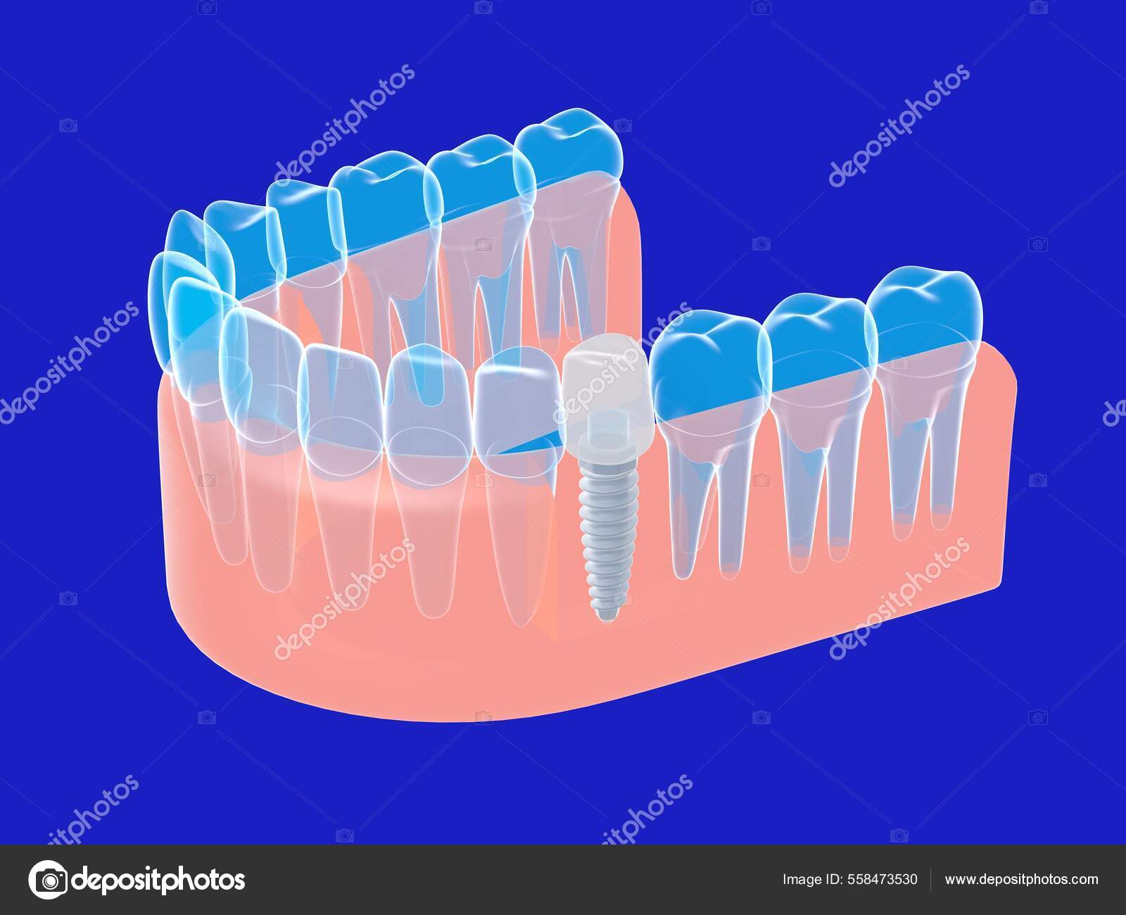Download - 3d illustration of a graphic, isometric style dental implant ...