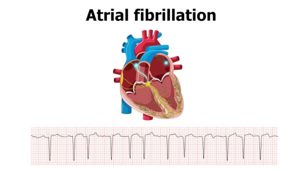 51 Atrial fibrillation Videos, Royalty-free Stock Atrial fibrillation ...