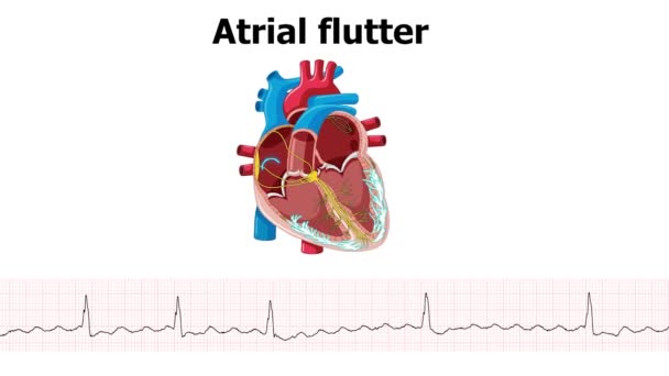 Ecg Shows Atrial Flutter Arrhythmia Heart Animation — Stock Video ...