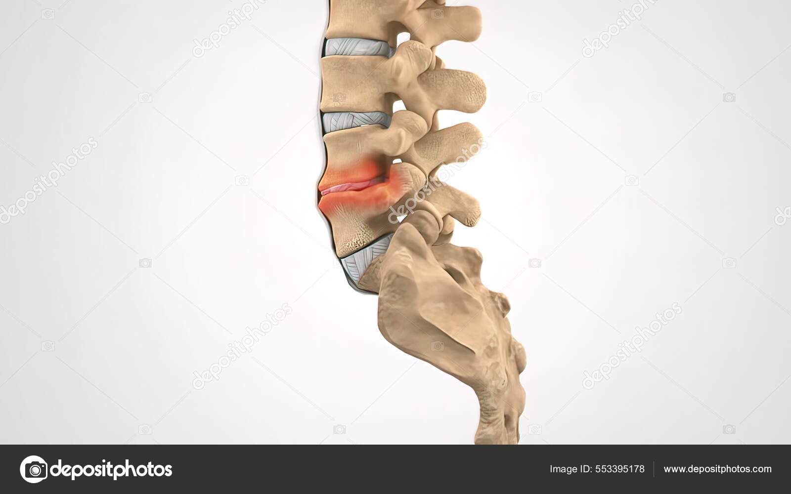 Backbone Laminectomy Degenerative Dics Disease Illustration Stock Photo ...