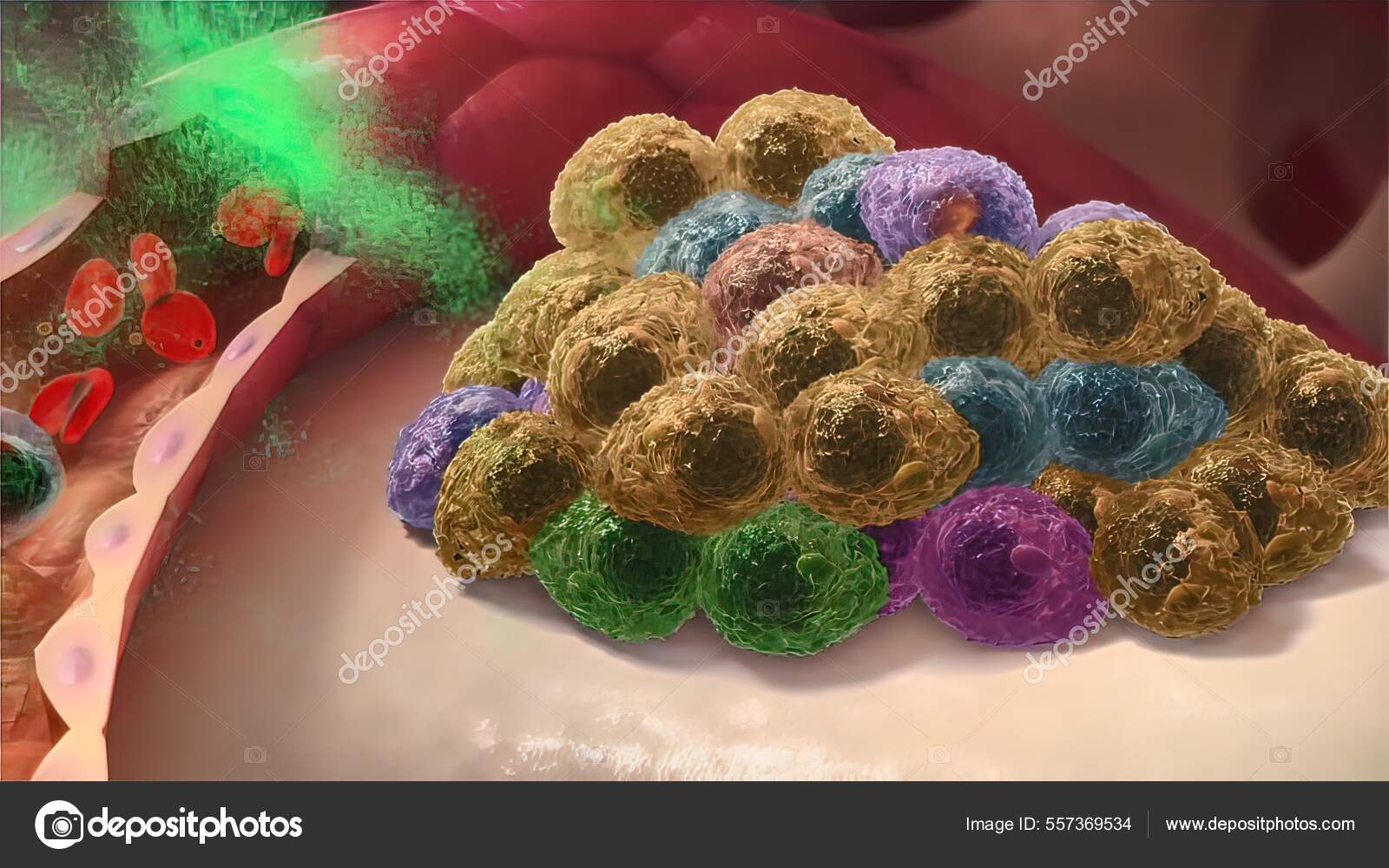 Multiple Myeloma Type Cancer Consists White Blood Cells Its Spread ...