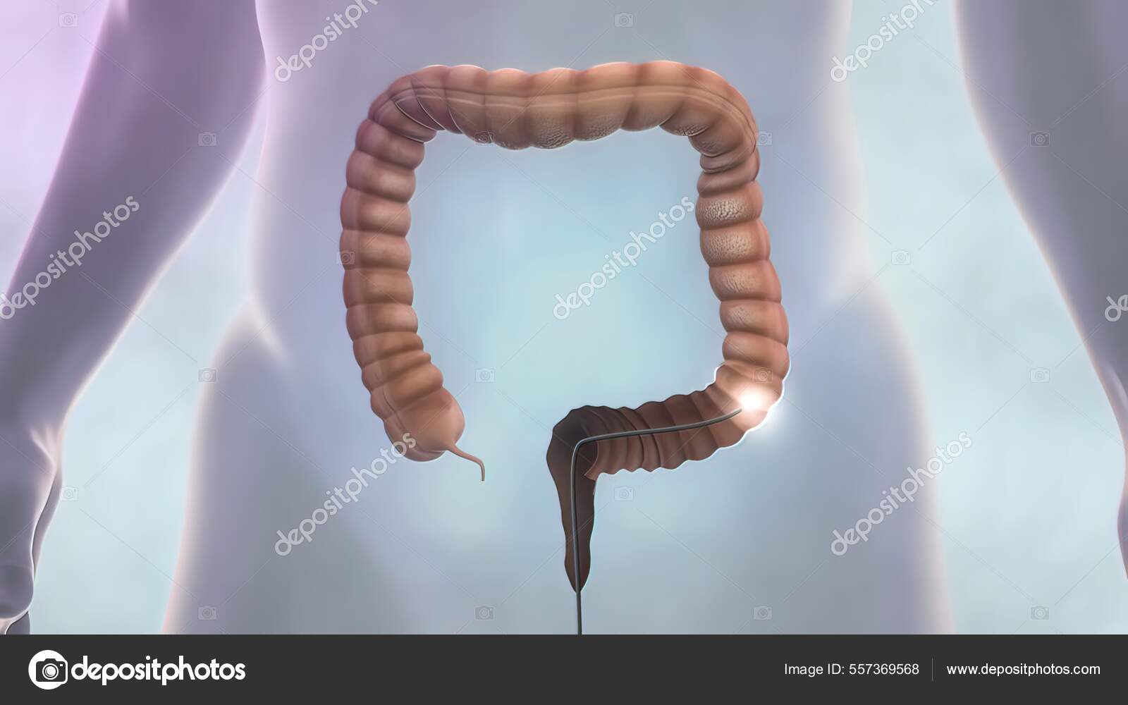Way Polyps Cancerous Cells Abnormal Structures Large Intestine Can ...
