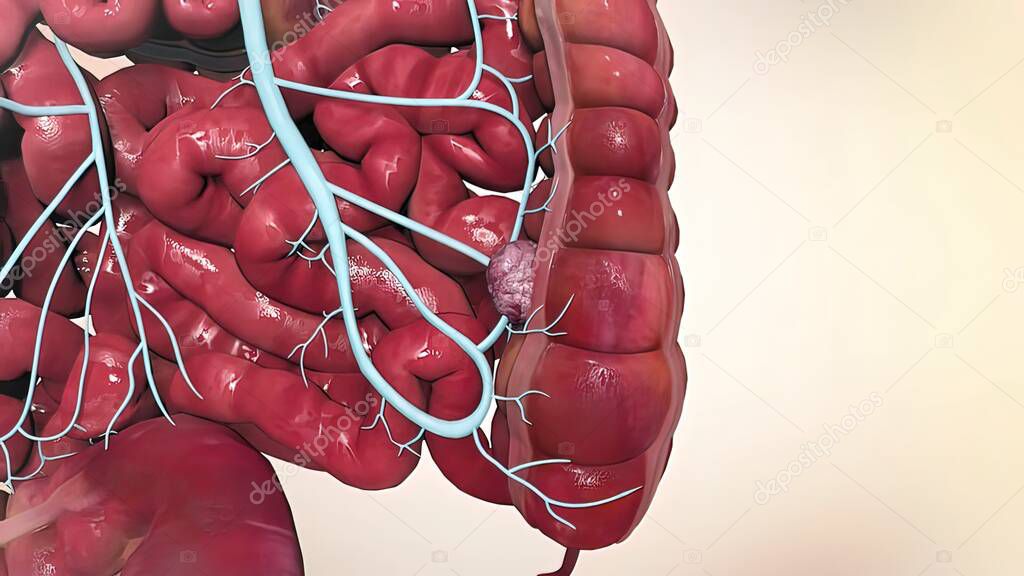 Las células cancerosas del colon y el recto pueden invadir y dañar los ...