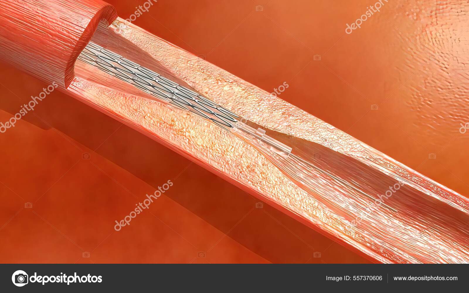 Hemoglobin Cells Flowing Blocked Artery Causing Arteriosclerosis ...