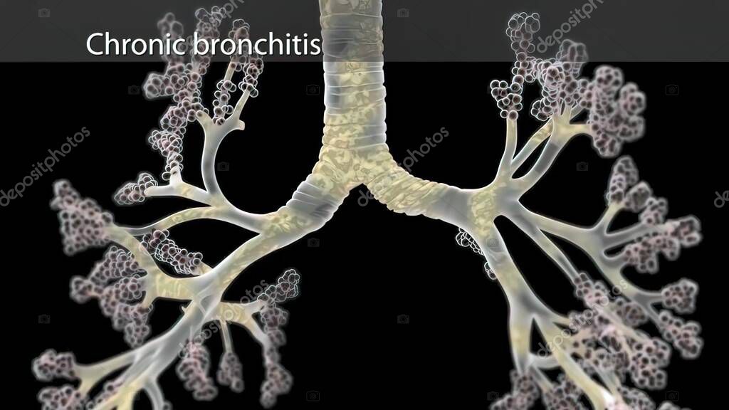La tos característica de la bronquitis es causada por la secreción ...