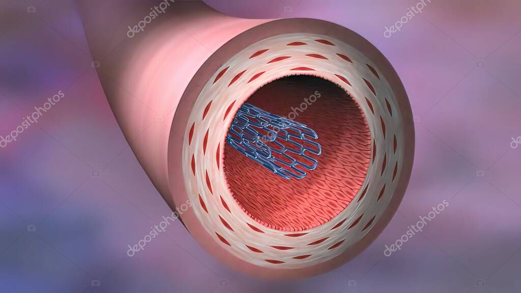 Una angioplastia coronaria es un procedimiento que se usa para ...