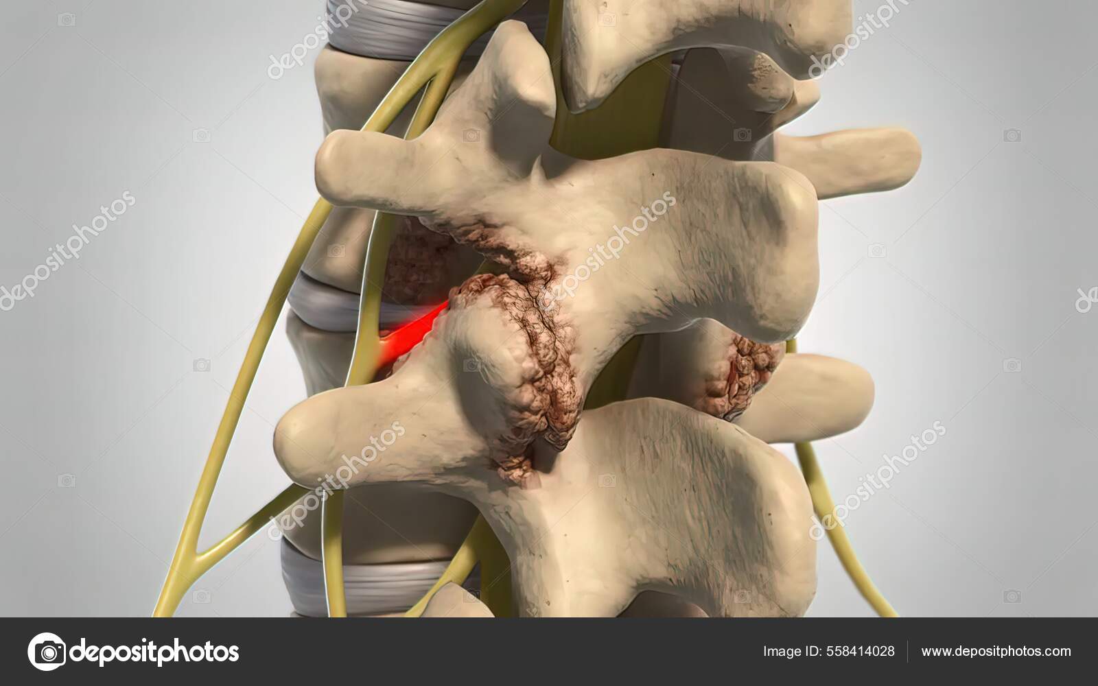 Pressure Nerve Roots Caused Spinal Cord Degeneration May Caused Slipped ...
