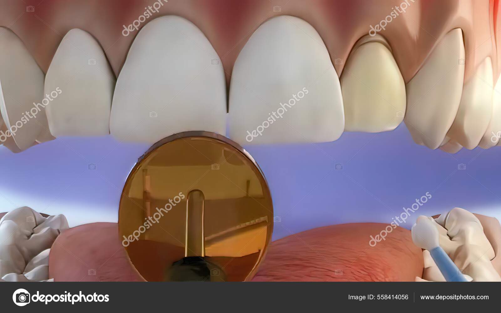 Tooth Coating Process Drying Adhesive Beam Illustration Stock Photo by ...