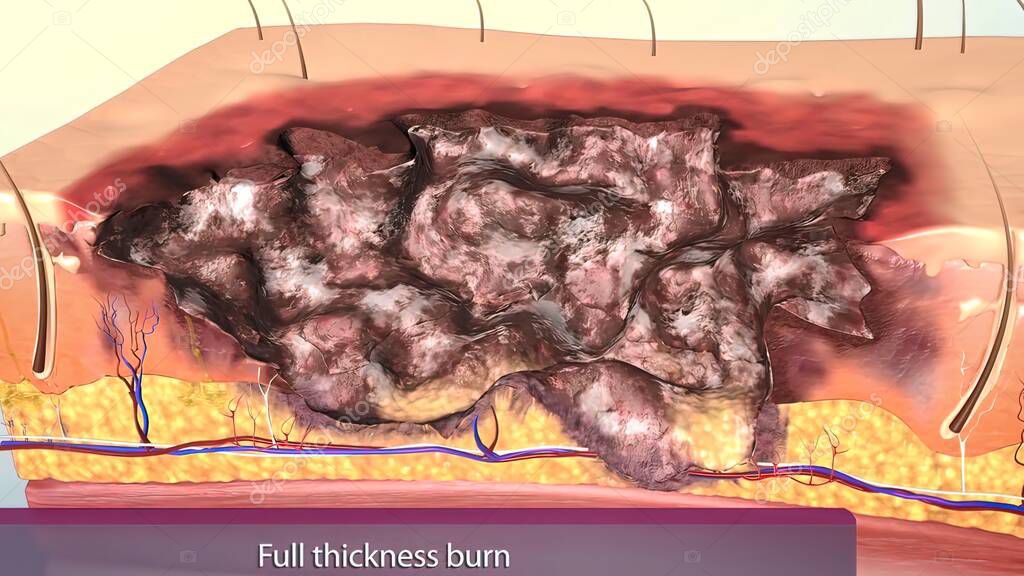 Las quemaduras de espesor completo son quemaduras de tercer grado ...