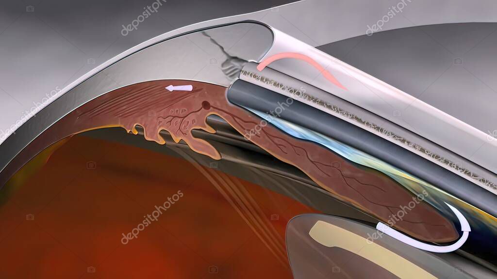 Simulation of development of glaucoma: aqueous humor is secreted into ...