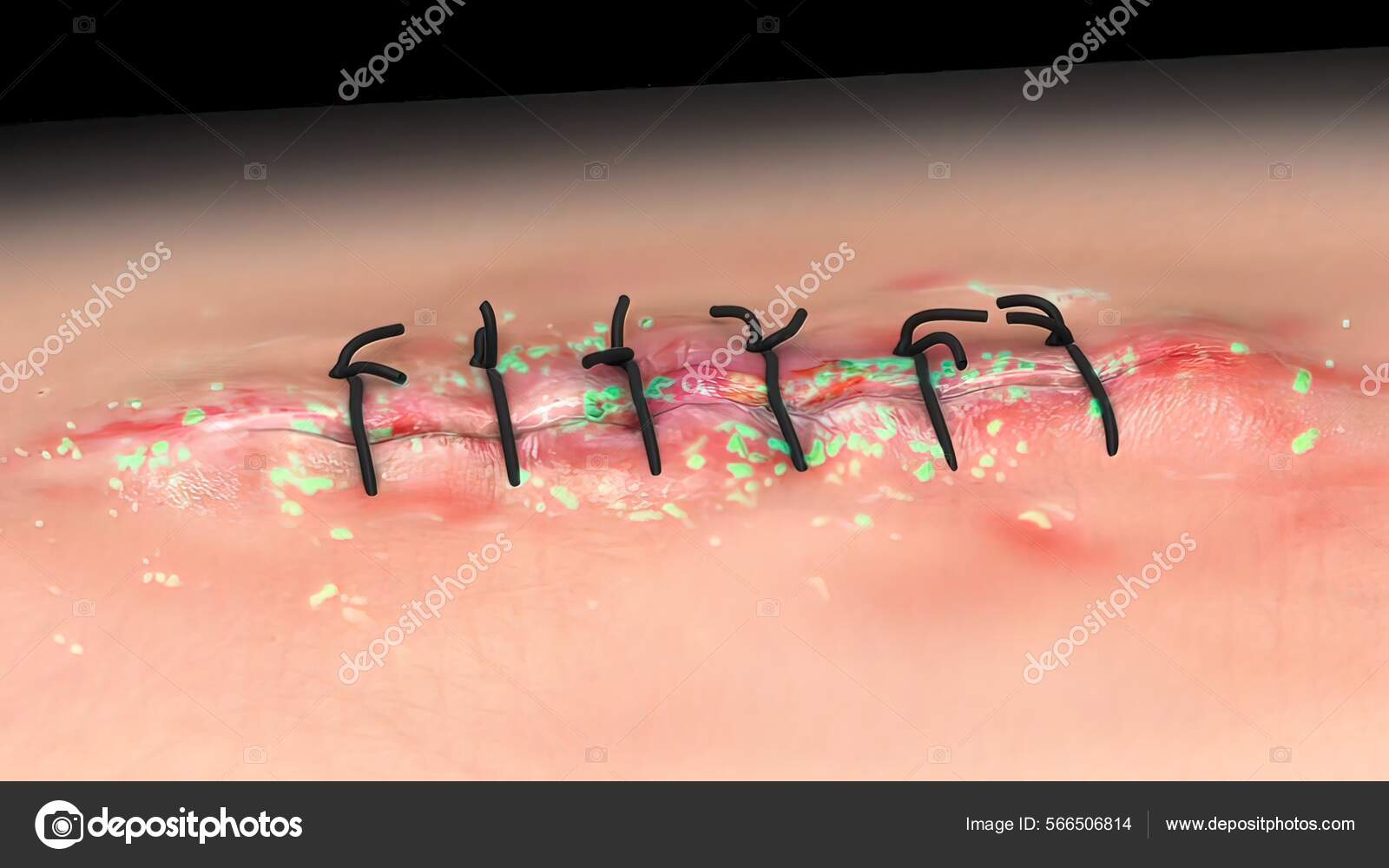 Wound Infection Occurs Bacteria Enters Break Skin Infection May Involve ...