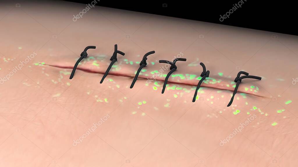 Una infección de la herida ocurre cuando la bacteria entra en una ...