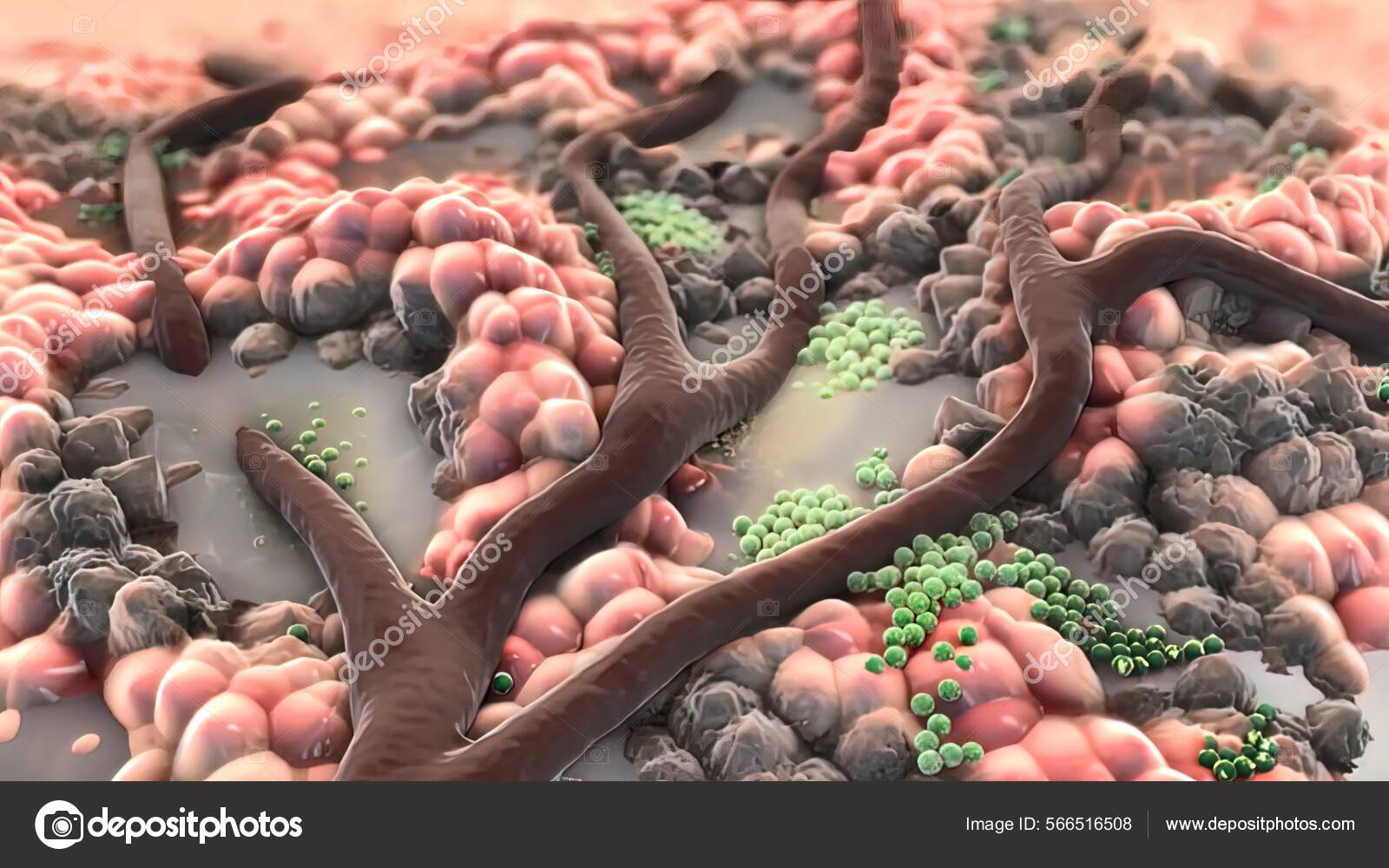 Abscess Collection Pus Has Built Tissue Body Illustration Stock Photo ...