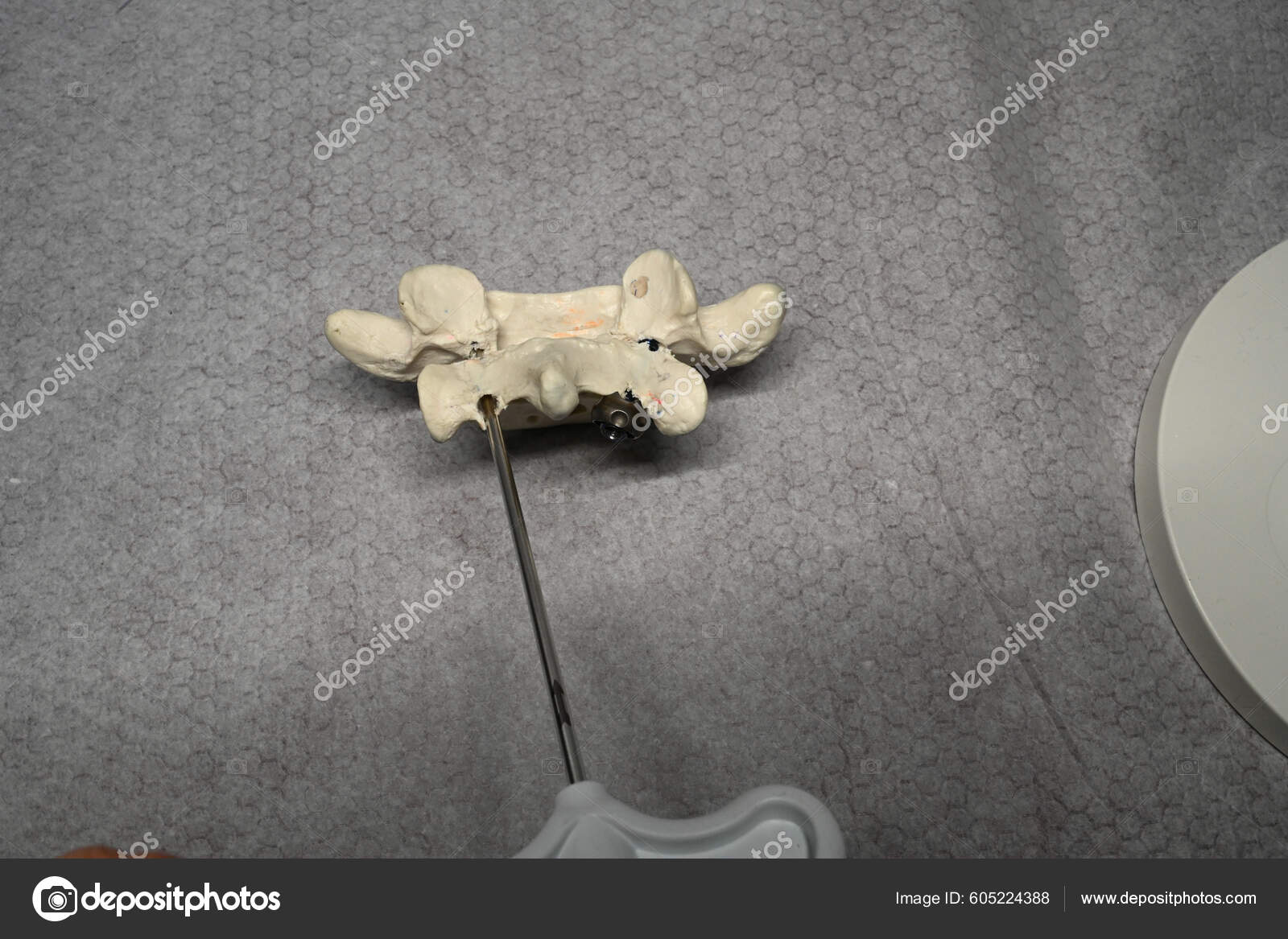 Lomber Lumbar Vertebrae Pars Fracture Spine Surgery Model ...