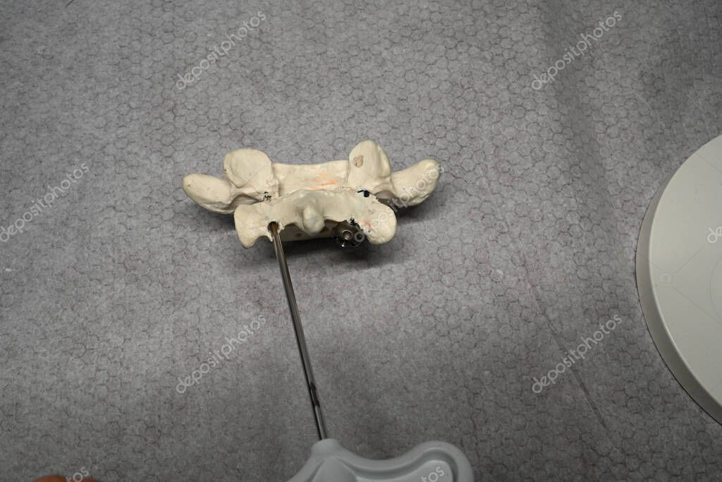 Lomber Lumbar Vertebrae Pars Fracture Spine Surgery Model ...
