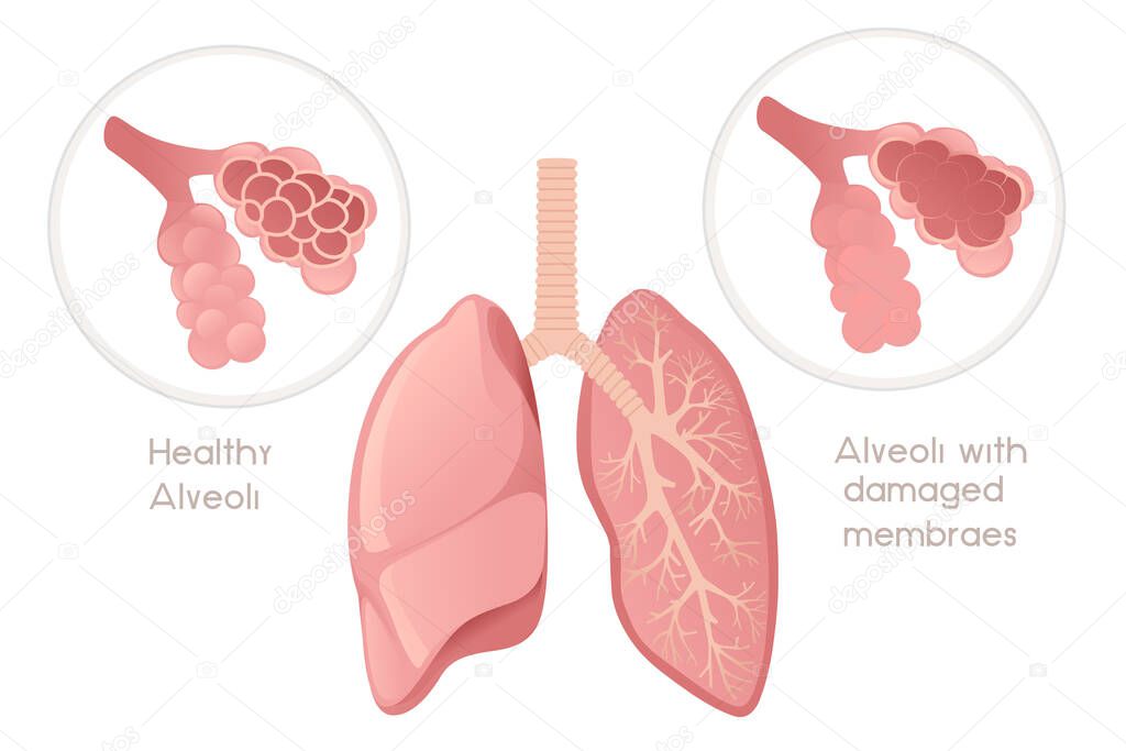 Humano Pulmones Alvéolos Con Membrana Dañada Diseño Dibujos Animados ...