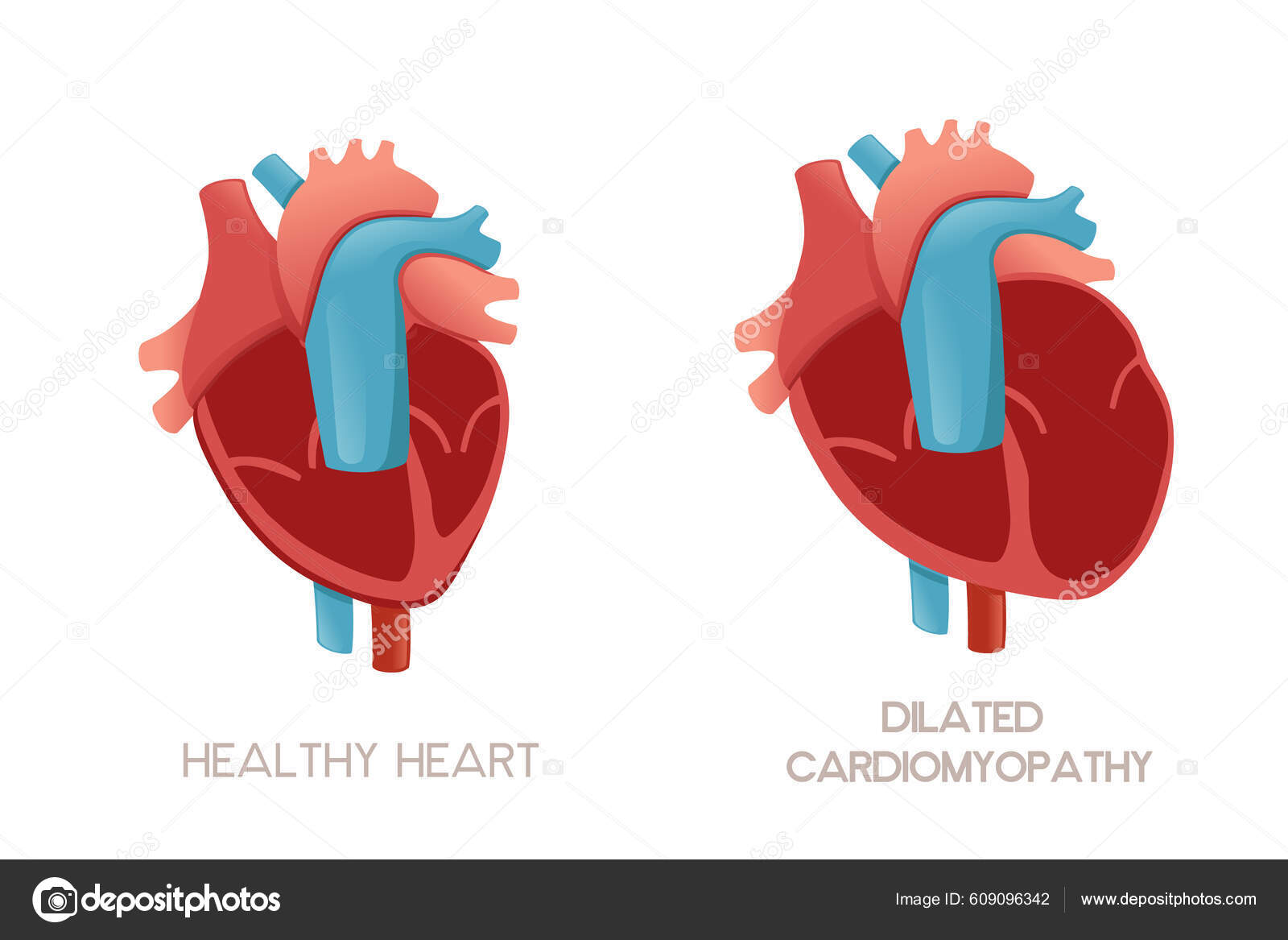 Healthy Human Heart Heart Dilated Cardiomyopathy Disease Anatomy ...